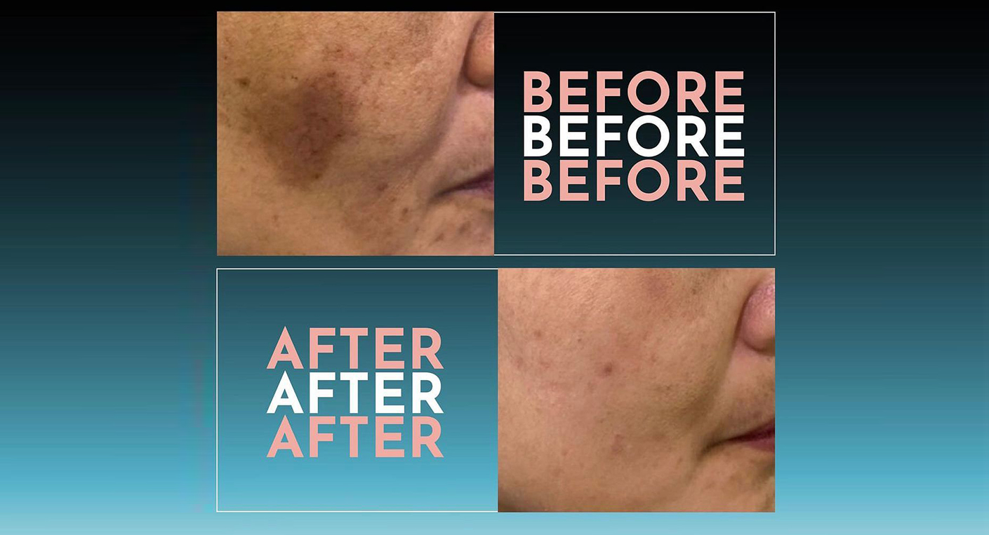 Les Exosomes Exomide, la nouvelle révolution en médecine esthétique et ...